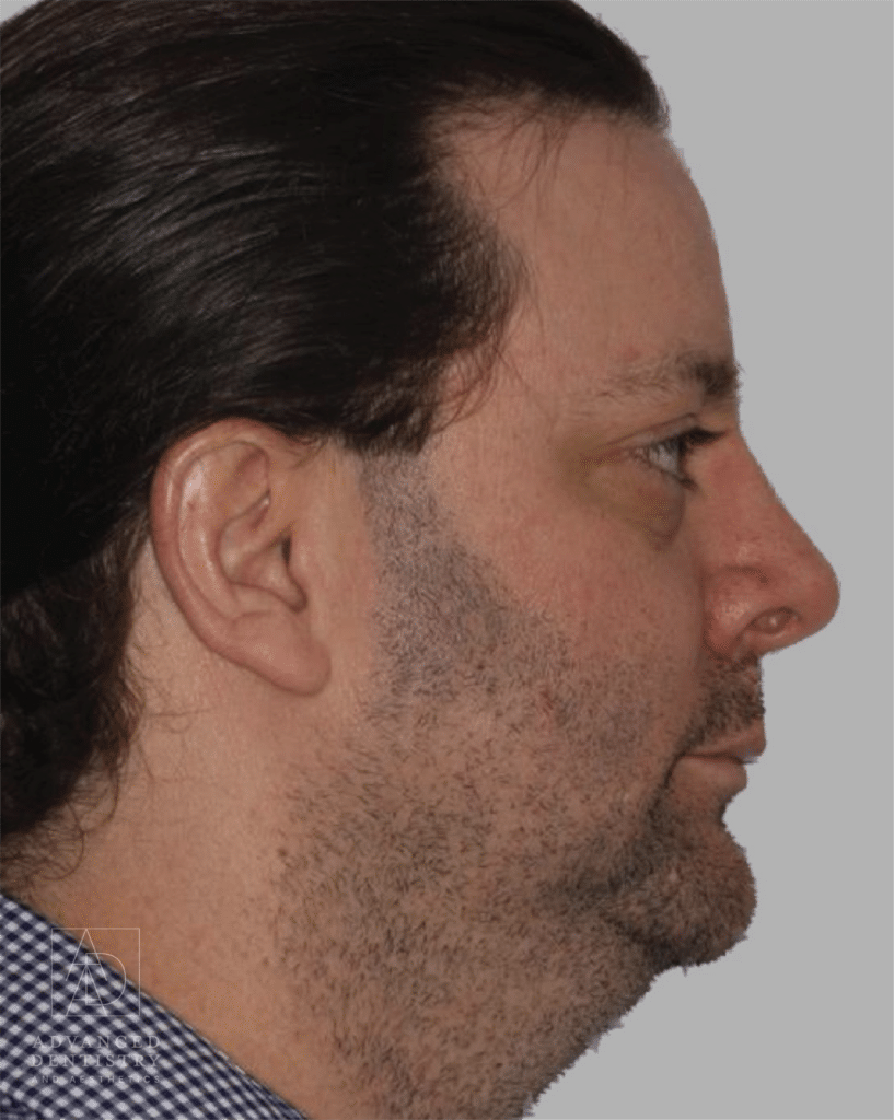 Functional Orthodontics Gallery | Advanced Dentistry & Aesthetics ...