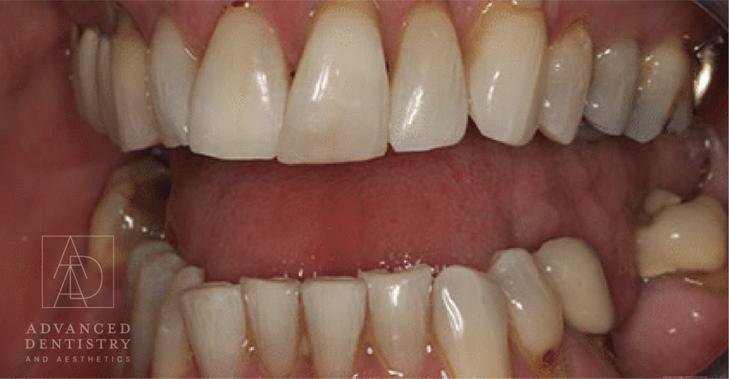 Teeth Whitening Gallery | Advanced Dentistry & Aesthetics | Dentistry ...