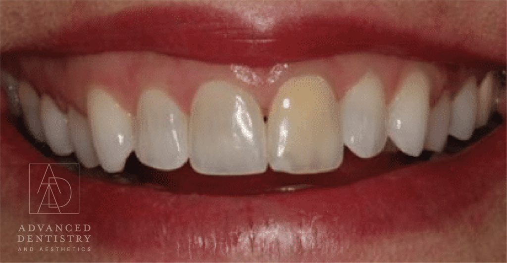 Teeth Whitening Gallery | Advanced Dentistry & Aesthetics | Dentistry ...