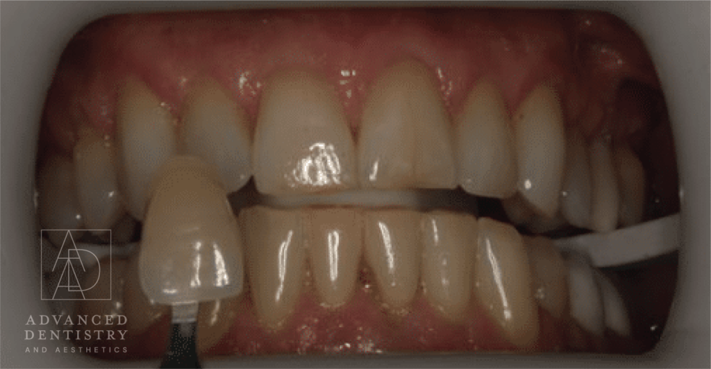 Teeth Whitening Gallery | Advanced Dentistry & Aesthetics | Dentistry ...