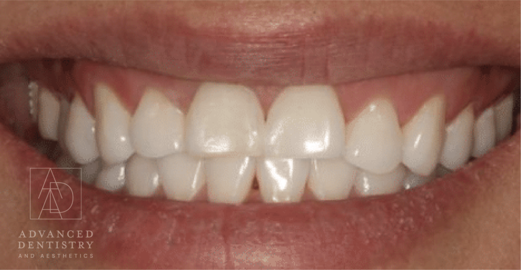 Teeth Whitening Gallery | Advanced Dentistry & Aesthetics | Dentistry ...